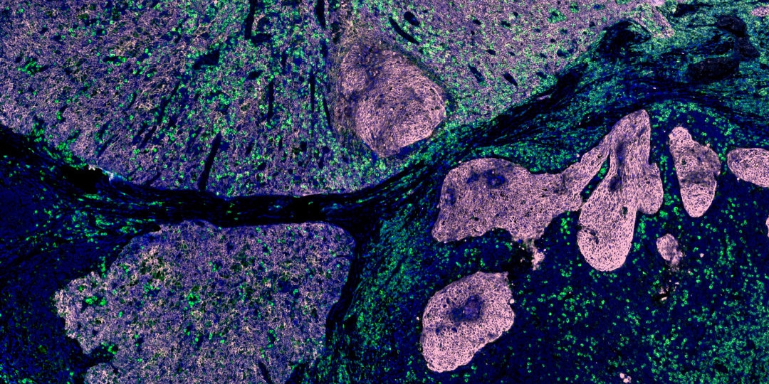 Malignant mesothelioma research